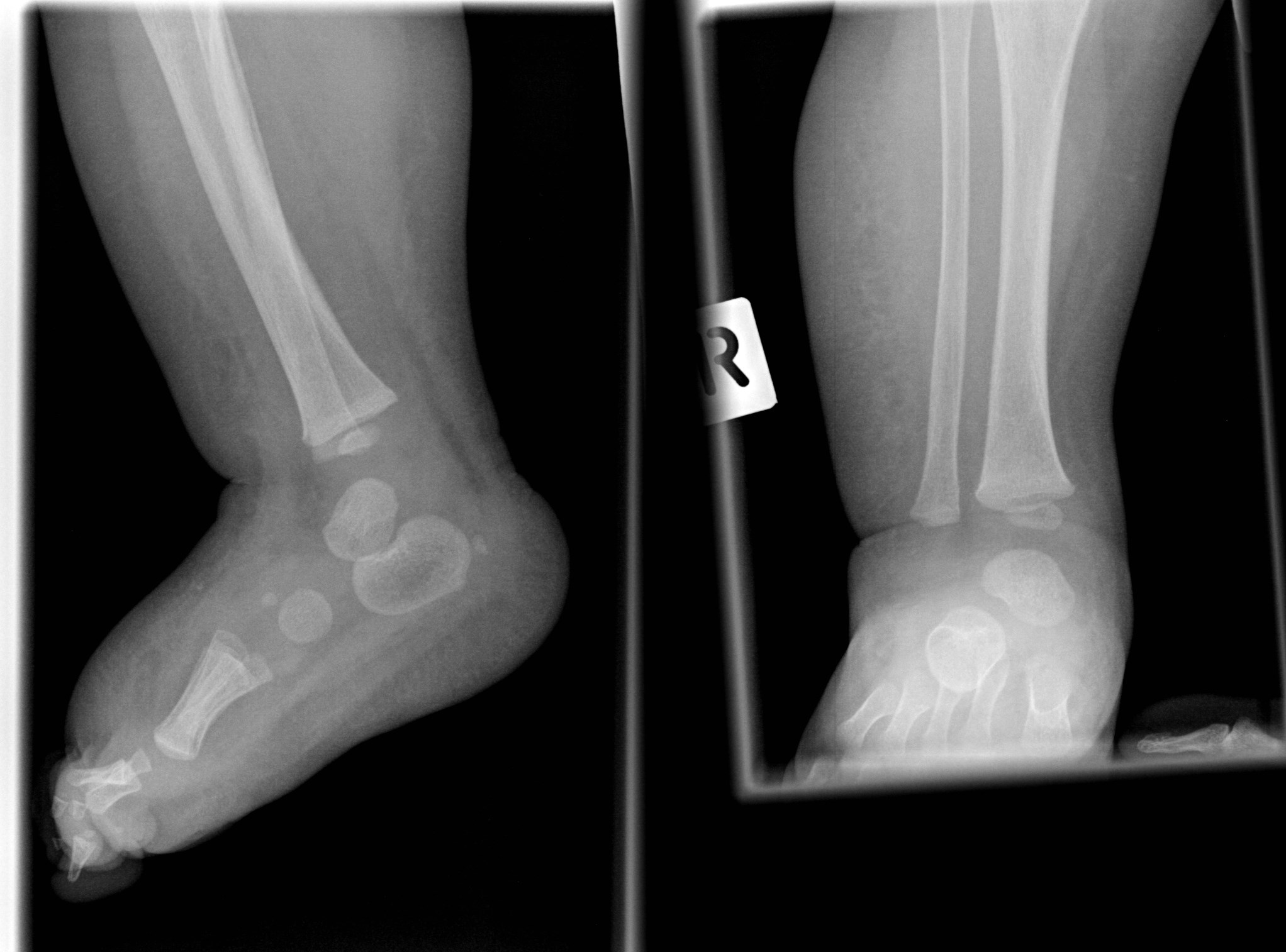 NORMAL PEDIATRIC BONE XRAYS BoneXray NORMAL PEDIATRIC BONE XRAYS BoneXray